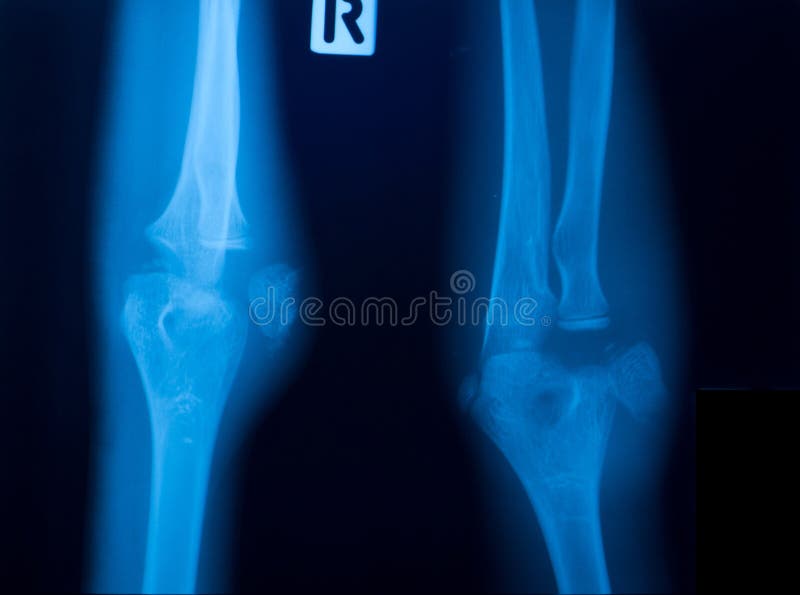 Radiografia Da Anca E Do Fémur De Um Cão, Com Sinais De Panosteíte Nos ...