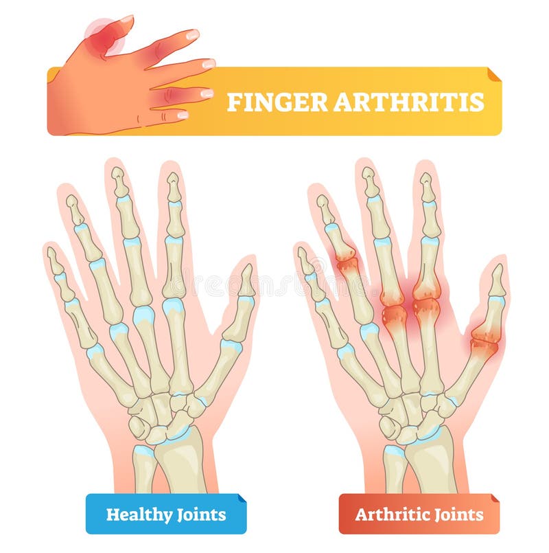 Finger Anatomy Medical Vector Illustration with Bones, Muscle Scheme ...