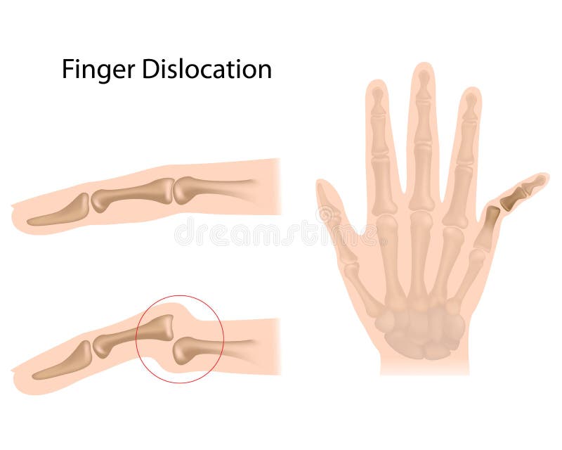 Hip dislocation stock vector. Illustration of anatomical - 28110054