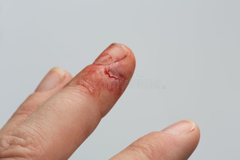Finger injury stock photo. Image of hand, injury, treatment - 46526794