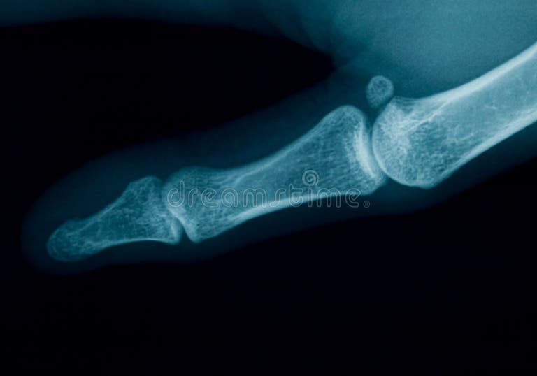 X Ray Middle Finger Stock Photos - Free & Royalty-Free Stock Photos ...