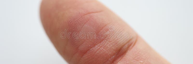 179 Finger Abscess Stock Photos - Free & Royalty-Free Stock Photos from ...