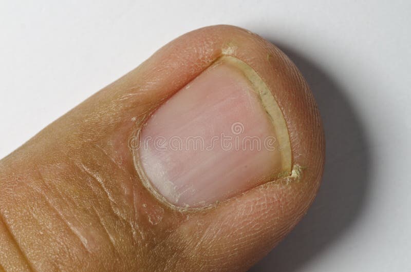 Finger tip stock image. Image of skin, keratin, dermal - 93184587
