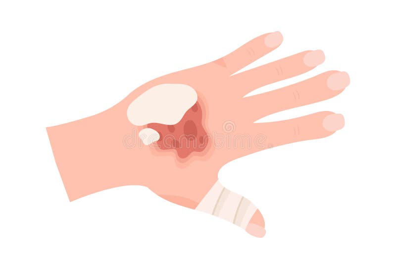 First Aid Bandaged Hand stock vector. Illustration of injury - 277675351