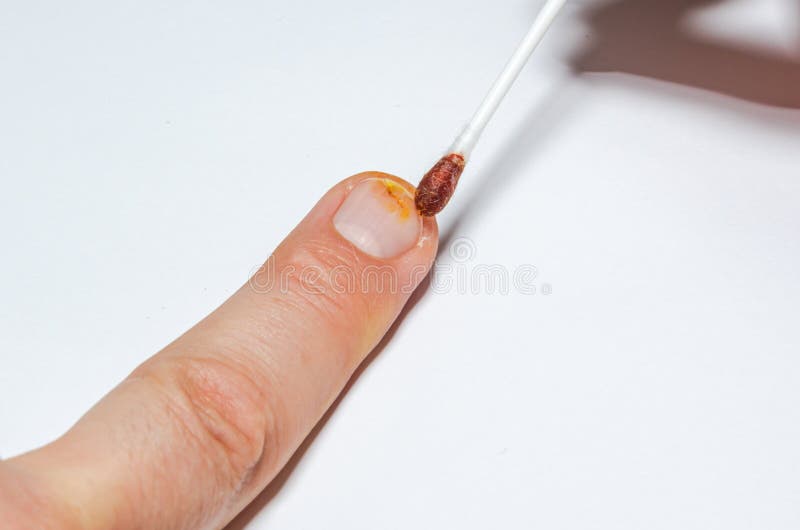 First Aid for a Patient with a Broken Fingernail Stock Image - Image of ...
