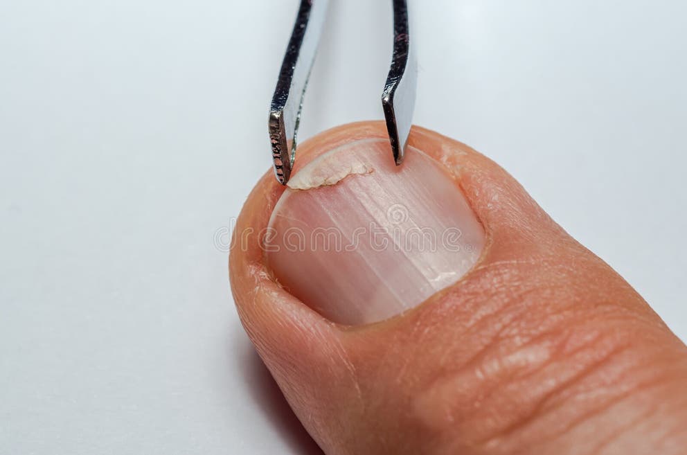 First Aid for a Patient with a Broken Fingernail Stock Image - Image of ...