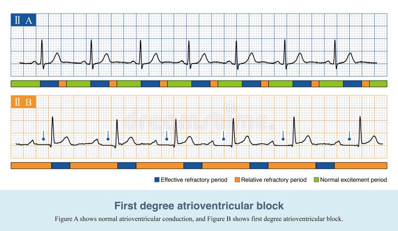 First Degree Atrioventricular Block Stock Illustration - Illustration ...