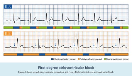 First Degree Atrioventricular Block Stock Illustration - Illustration ...