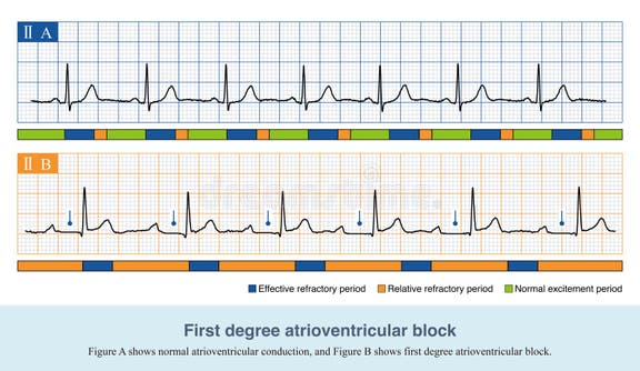First Degree Atrioventricular Block Stock Illustration - Illustration ...