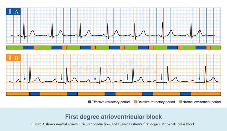 First Degree Atrioventricular Block Stock Illustration - Illustration ...
