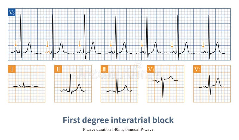 First Degree Interatrial Block Stock Illustration - Illustration of ...