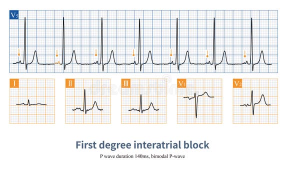 First Degree Interatrial Block Stock Illustration - Illustration of ...