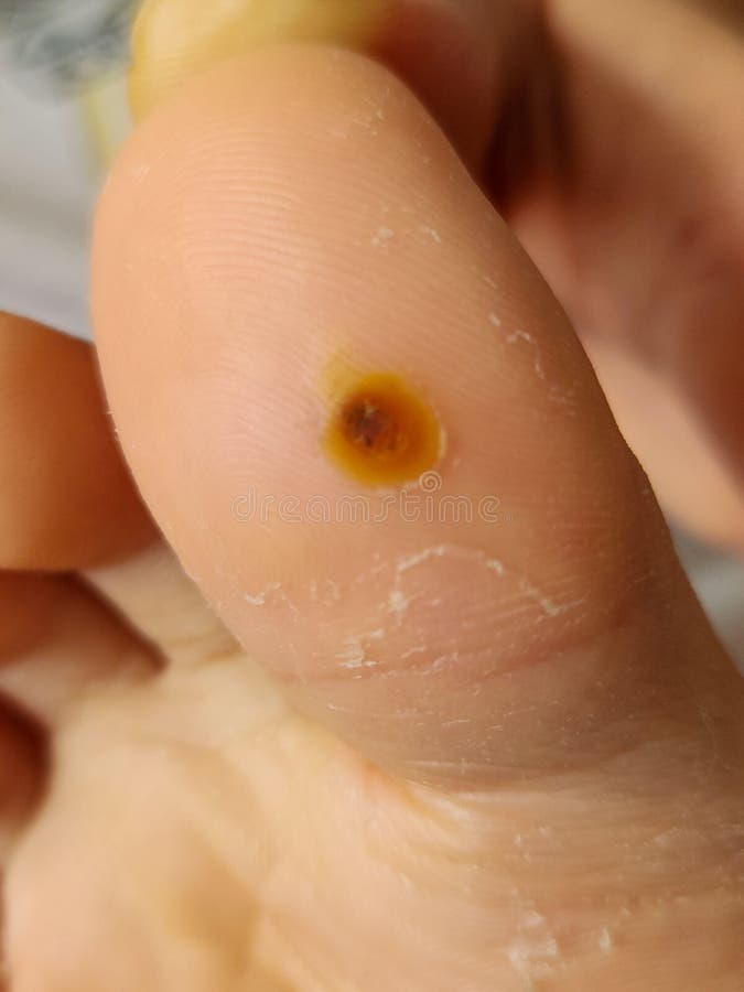 Fish eye on big toe stock image. Image of peeling, skin - 351673777