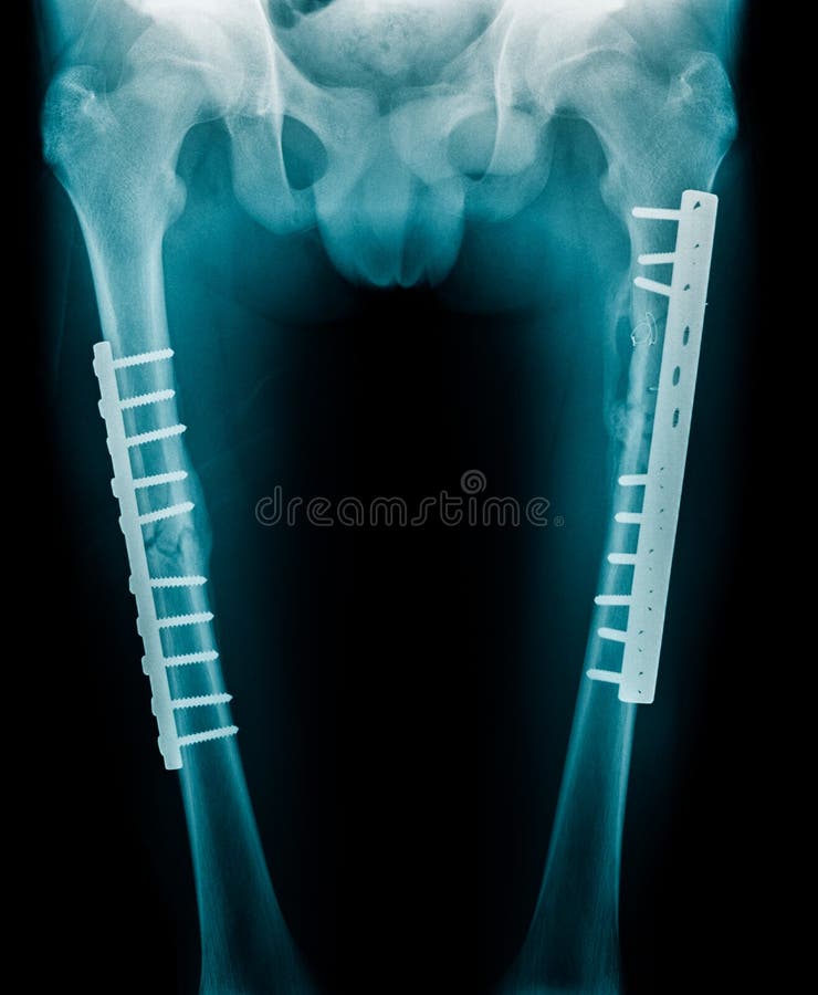 Fissazione Dell'anca Per Il Paziente Anziano Con La Frattura Dell'anca ...