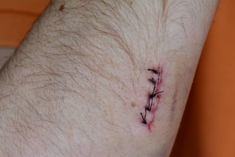 Five Stitches on the Forearm Stock Photo - Image of close, suture ...