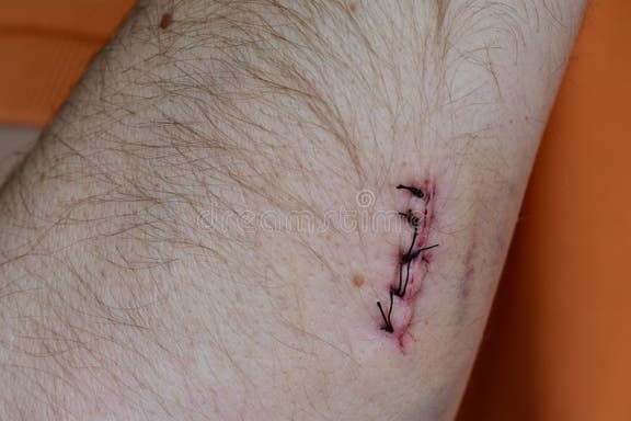 Five Stitches on the Forearm Stock Photo - Image of close, suture ...