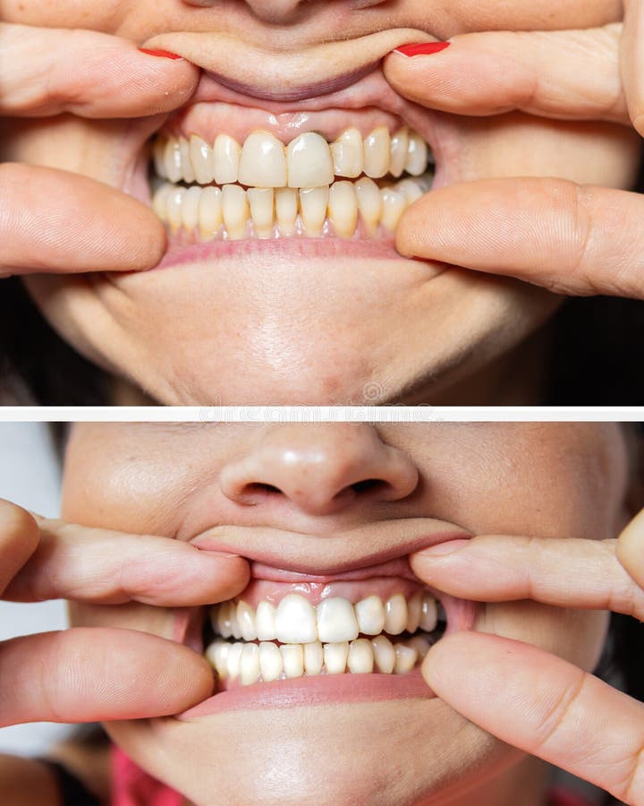 Fix, Repair and Teeth Whitening, before and after Stock Photo - Image ...