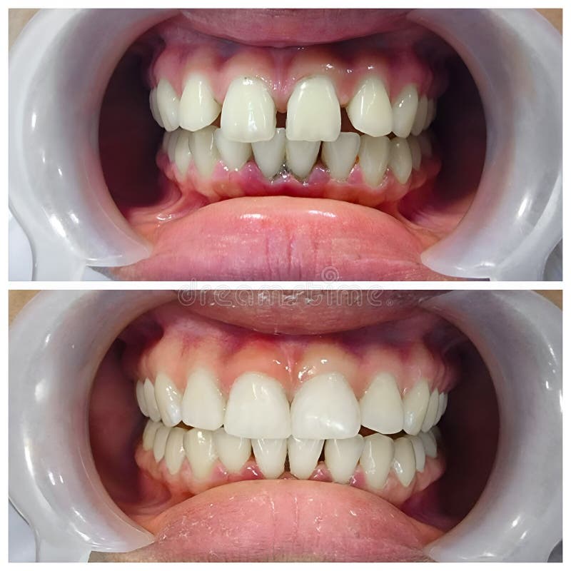 Before and after Fixation for Huge Gap between Front Teeth or Incisors ...