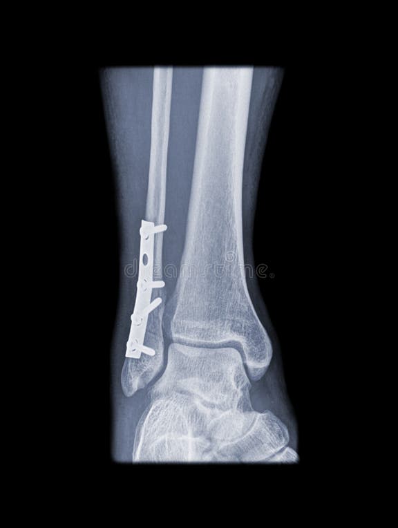 Fixed weber b fracture stock image. Image of graphic - 13617623