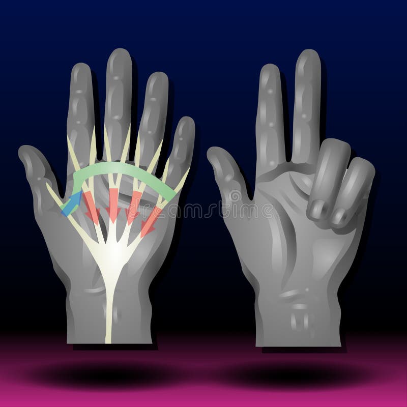 Hand Bone Fracture - Distal Radius Fracture and Broken Arm Bone Types ...