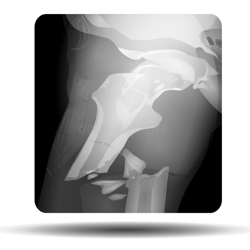 X Ray Of Broken Thigh Bone Human Anatomy Healthcare Science Stock Illustration