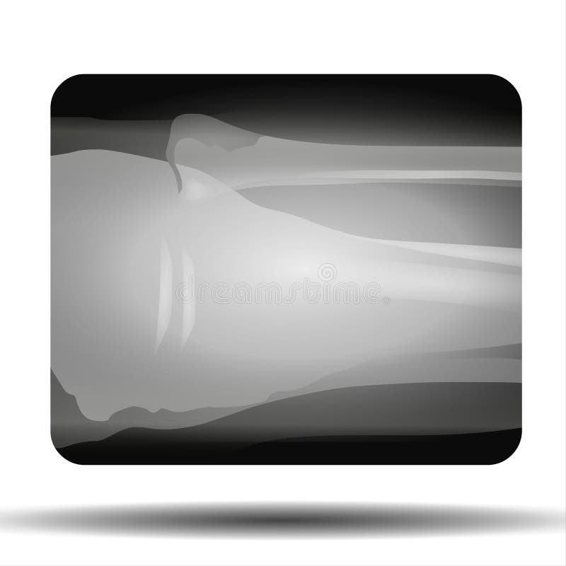 X-ray of the Knee Joint - Human Body - Science - Healthcare Stock ...