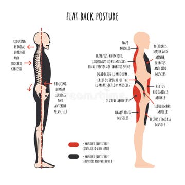 Flat Back Posture. the Side View Shows Characteristic Decrease Natural ...