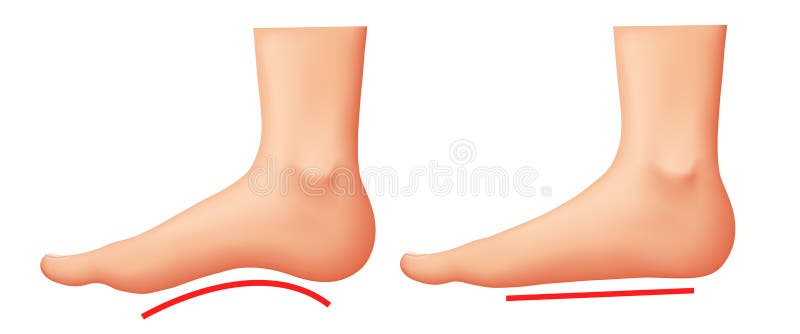 Flat Feet. Normal Foot and Flat Foot Stock Vector - Illustration of ...