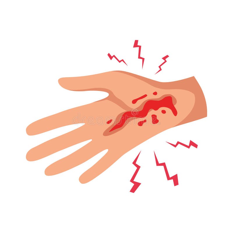 Flat Hand Injury stock vector. Illustration of icon - 275309765