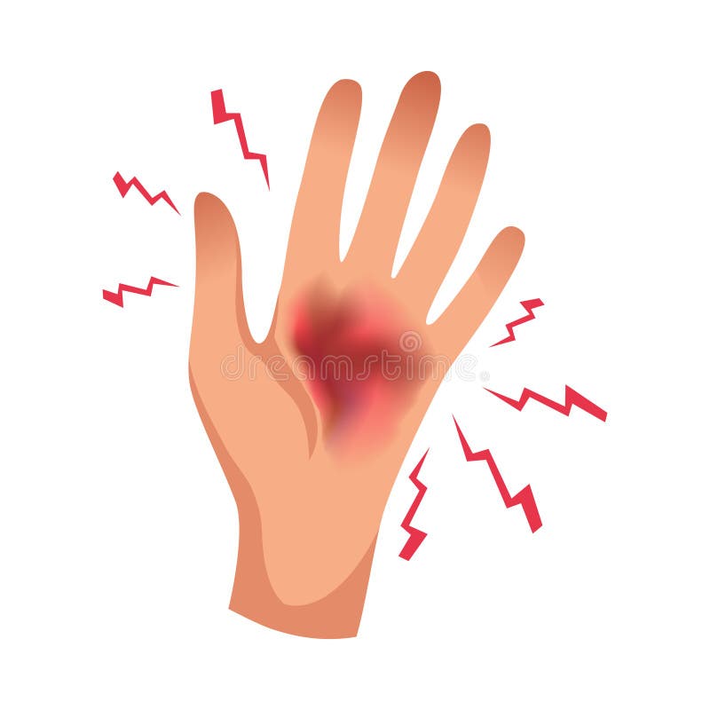 Flat Palm Burn stock illustration. Illustration of lifestyle - 275204525