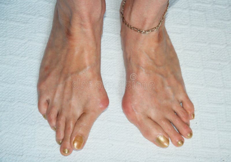 Floppy Feet Syndrome. Bone Misalignment.UK Stock Photo - Image of ...
