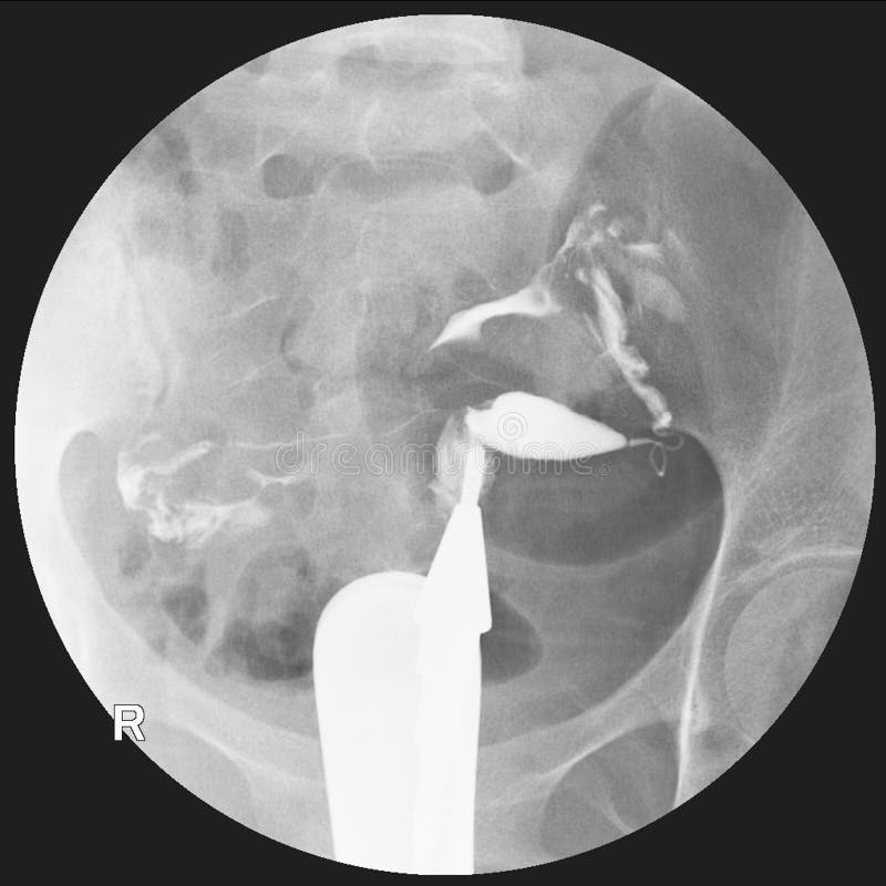 A Fluoroscopic X-ray Study of a Woman`s Uterus and Fallopian Tubes ...