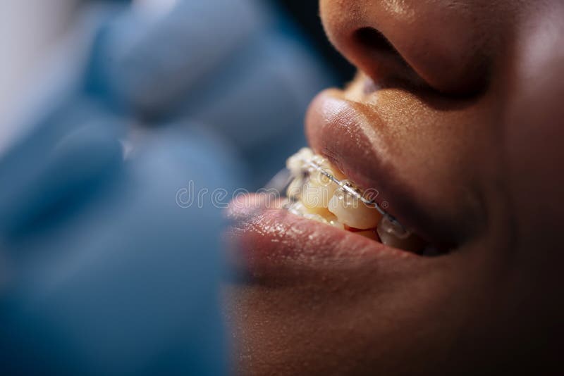 Focus of Smiling African American Woman in Braces Stock Image - Image ...