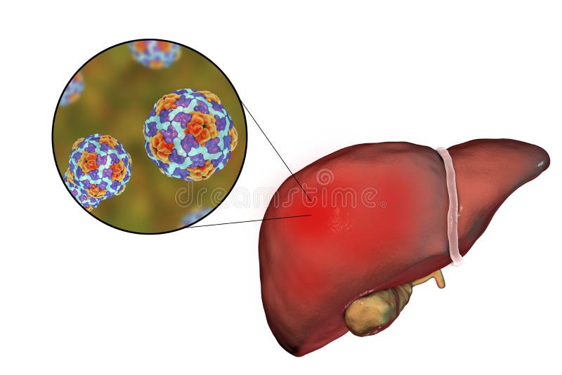 Foie Avec Linfection De Lhépatite A Et La Vue De Plan Rapproché De Lhépatite Un Virus