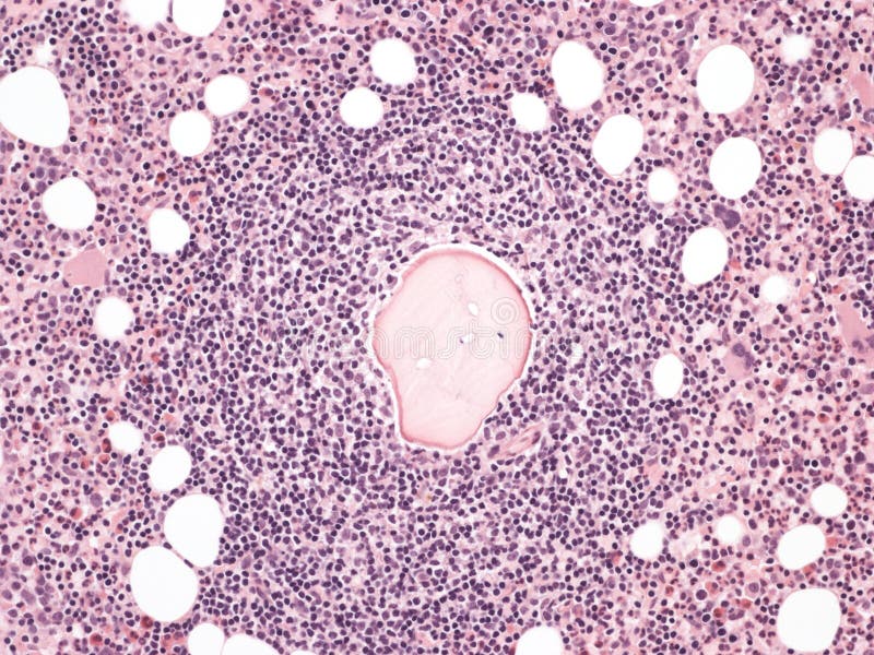 Follicular Lymphoma in Bone Marrow. Stock Photo - Image of pathology ...
