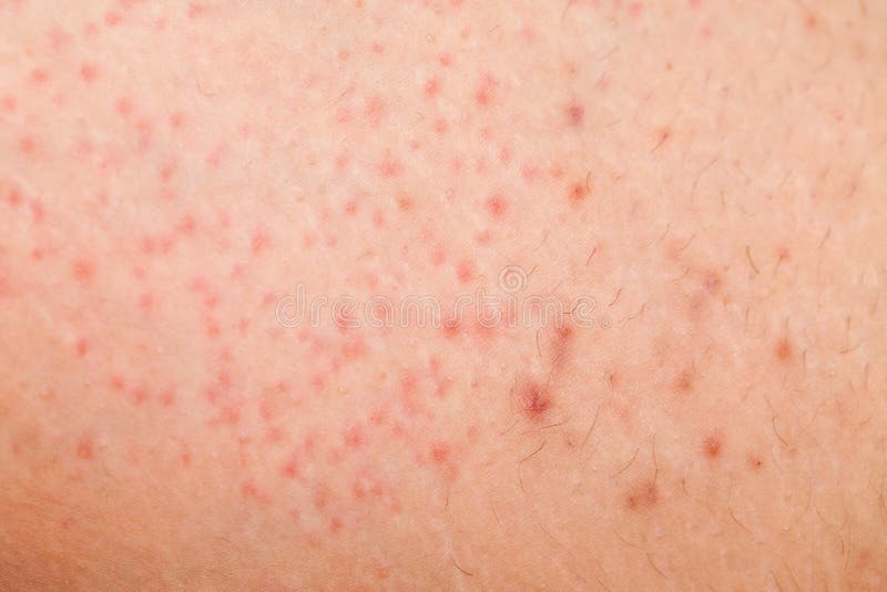 Folliculitis on Female Skin Stock Image - Image of cosmetic ...