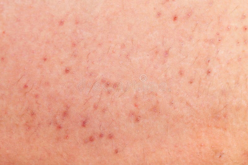 Folliculitis on human skin stock photo. Image of grow - 92850996
