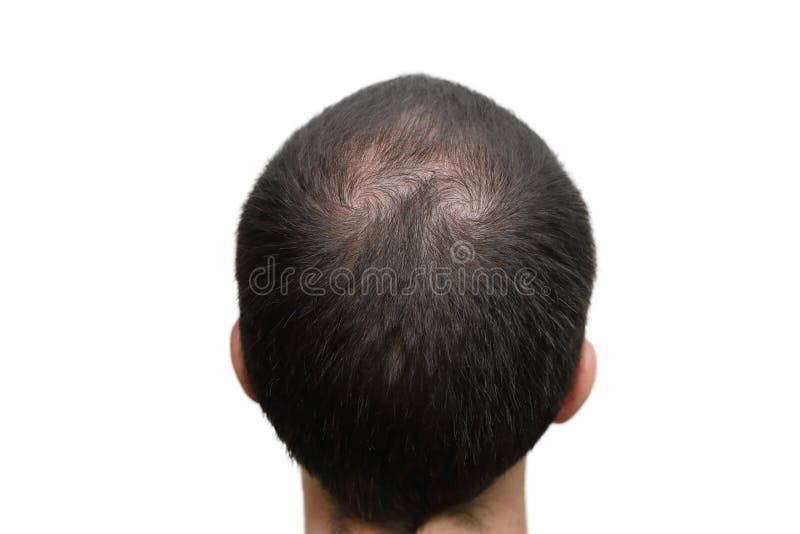 Fondo de la cabeza calva foto de archivo. Imagen de salud - 56534950