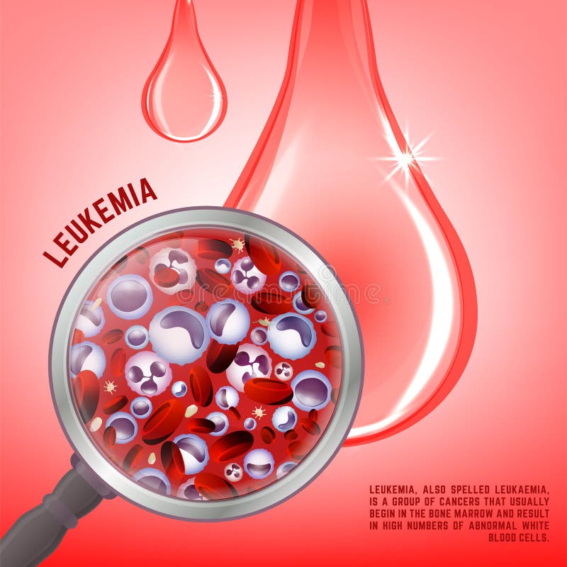 Imagen De Infographic De La Leucemia Ilustración del Vector ...