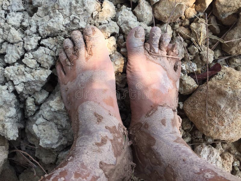 Dirty Foot Or Cracked Heels Isolate On White Background, Medical Or ...