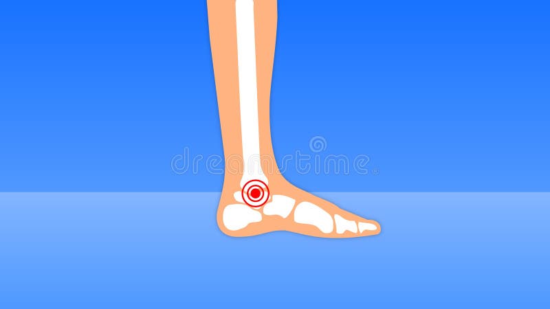 Foot Joint Anatomy Medical Illustration Stock Vector - Illustration of ...