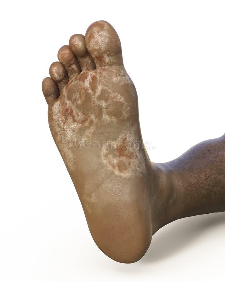 The Foot with Mycosis, and Close-up View of Fungi that Cause Athlete S ...