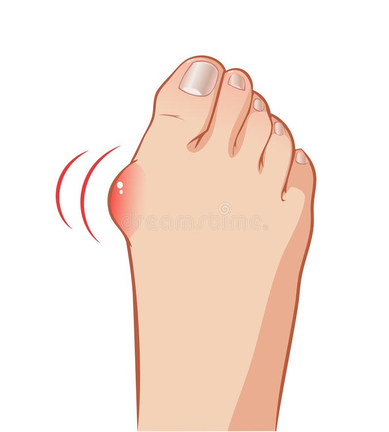 Foot with a painful bunion stock illustration. Illustration of foot ...