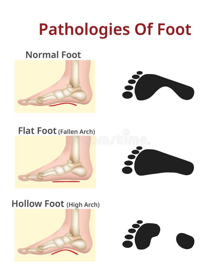 Foot Pathologies, Normal, Flat and Hollow Foot - Vector Illustration ...