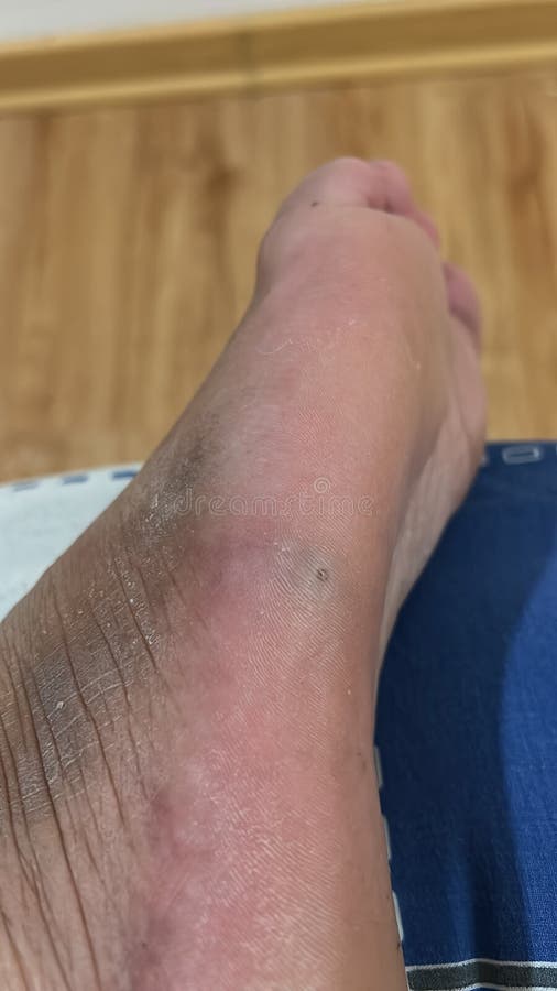 Foot stock image. Image of wound, surgery, minor, foot - 265839347