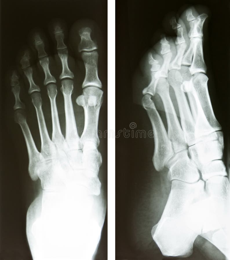 Foot radiography stock photo. Image of clinical, bone - 8655586