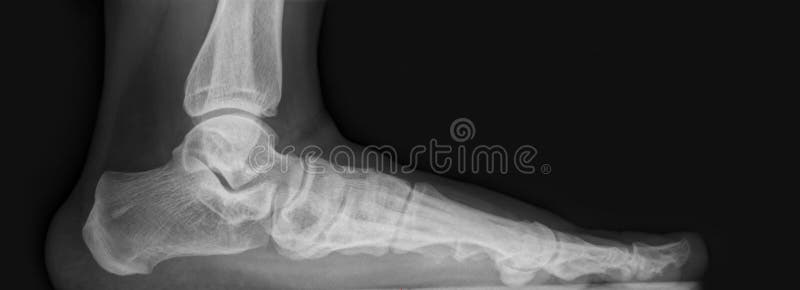 Xray/Foot side stock photo. Image of fracture, internal - 198834