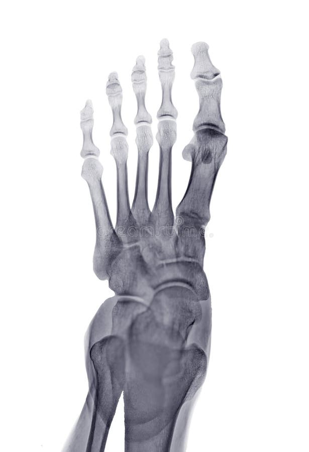 Foot X-ray Image Showing Dislocation of Toe Isolated on Black ...