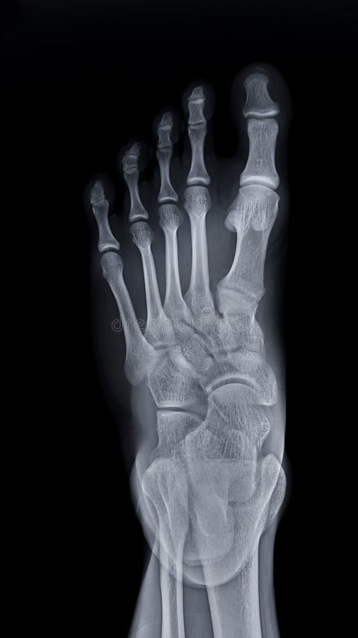 Foot X-ray Image Showing Dislocation of Toe Isolated on Black ...