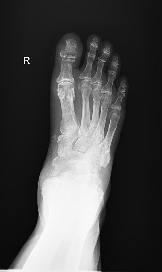 Foot X-ray Image the Body of the Patient Stock Image - Image of joint ...